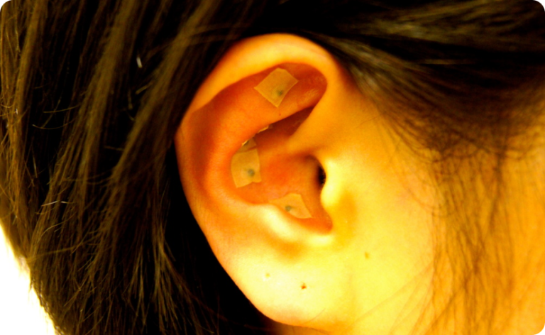 Ear Acupuncture - JED Clinic